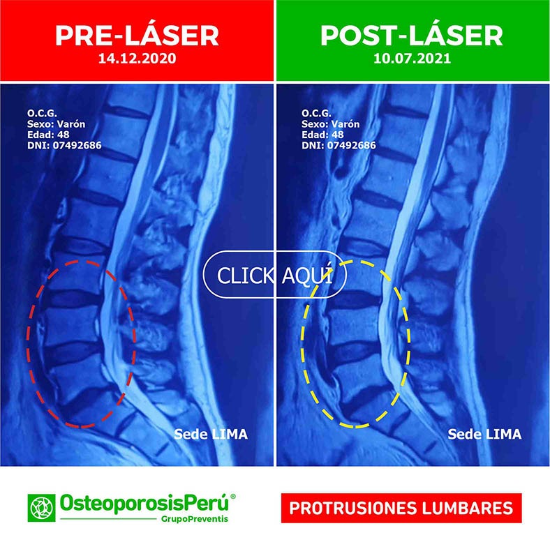 PROTRUSIONES LUMBARES - Osteoporosis Perú