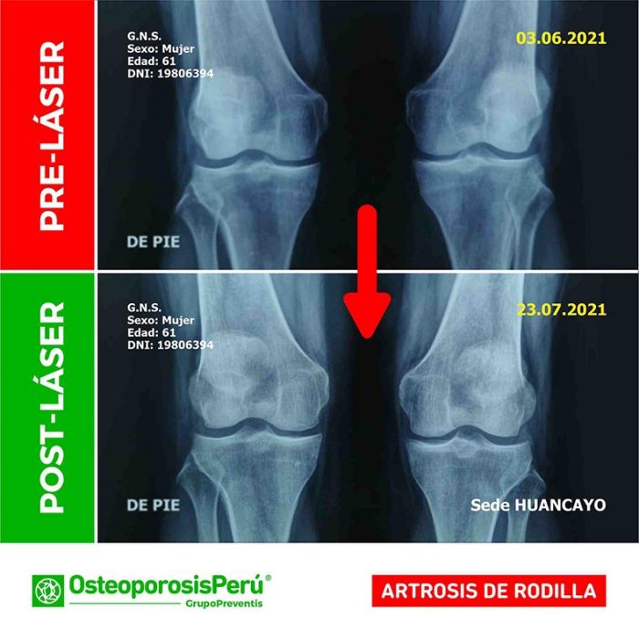ARTROSIS DE RODILLA - Osteoporosis Perú