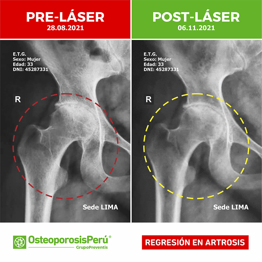 REGRESIÓN EN ARTROSIS - RX - Osteoporosis Perú