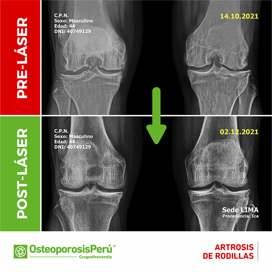 ARTROSIS DE RODILLAS - RX - Osteoporosis Perú