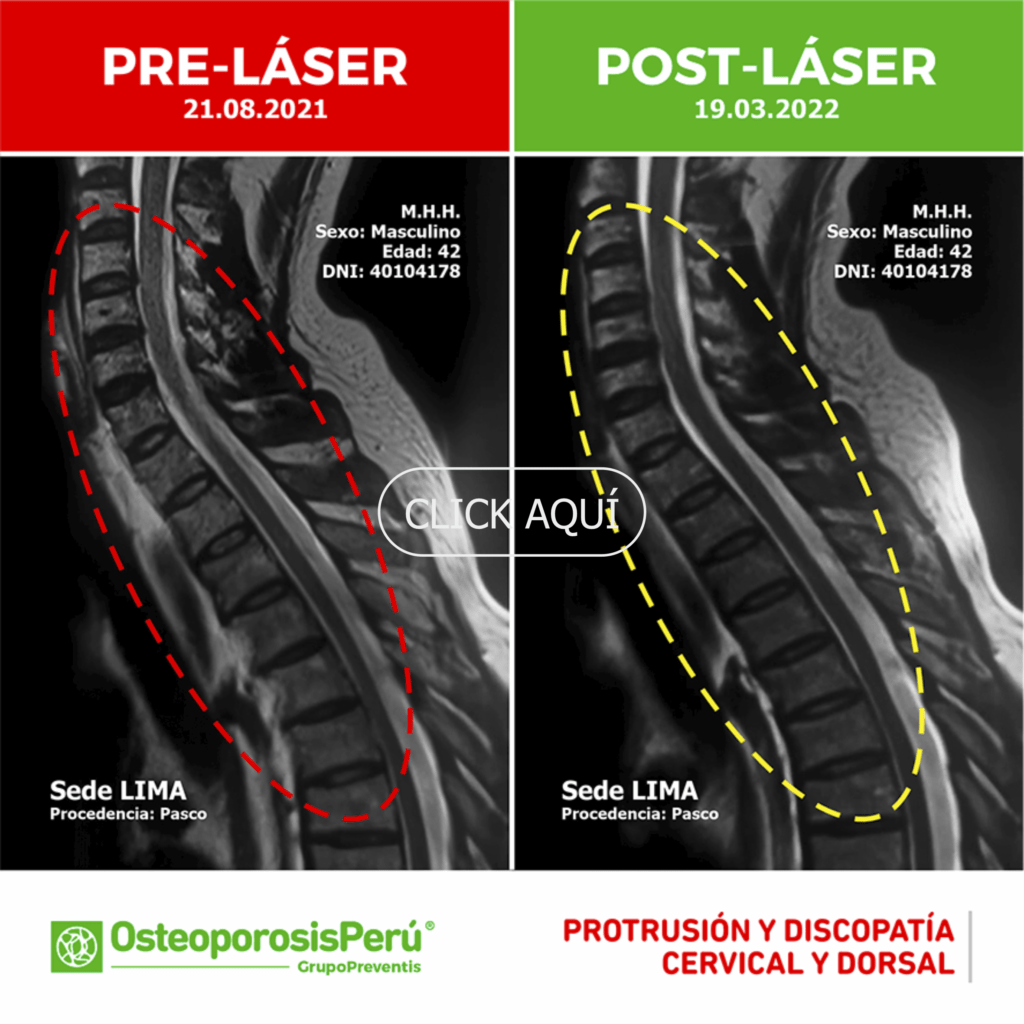 PROTUSIÓN Y DISCOPATÍA CERVICAL Y DORSAL - RX - Osteoporosis Perú