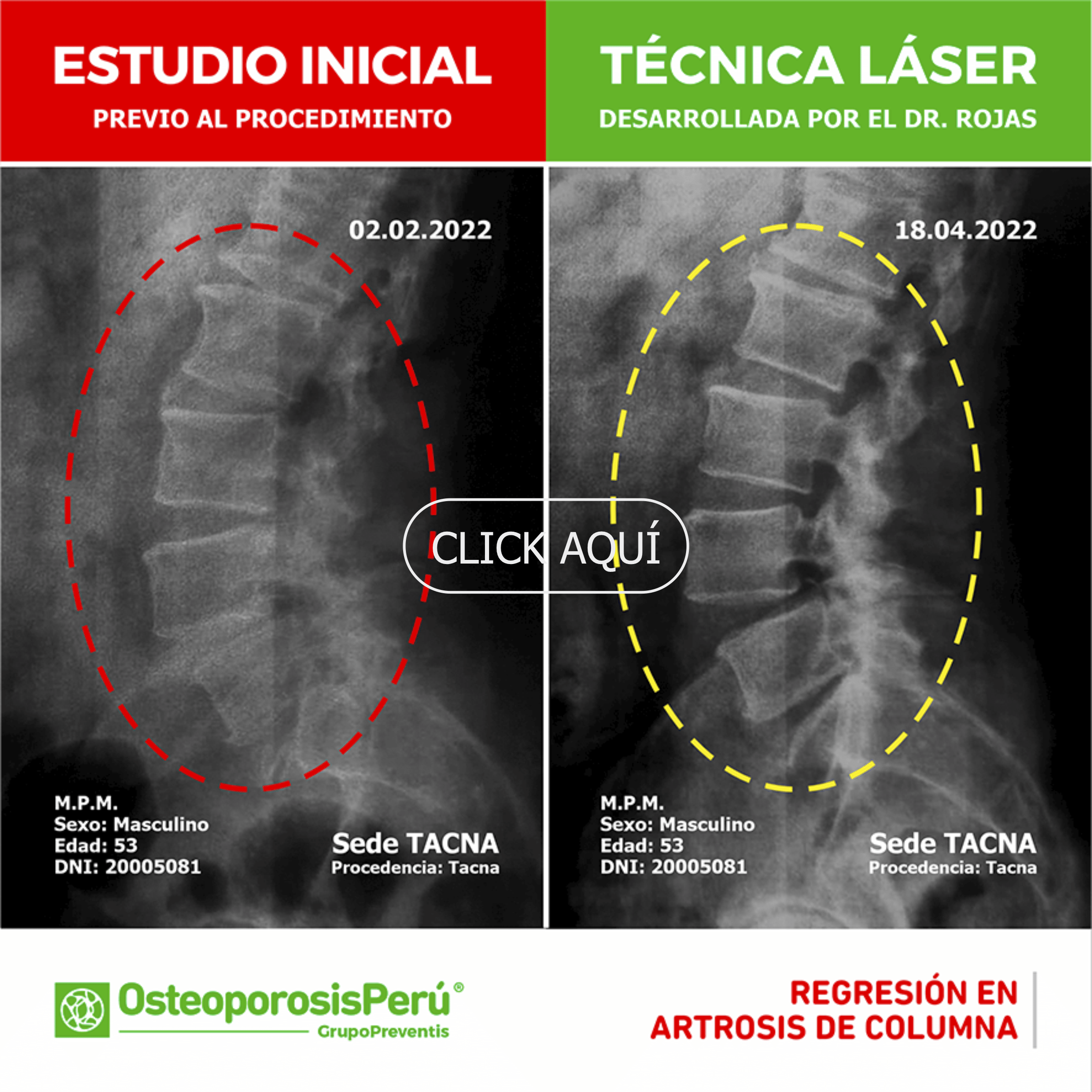 REGRESIÓN EN ARTROSIS DE COLUMNA - RX - Osteoporosis Perú