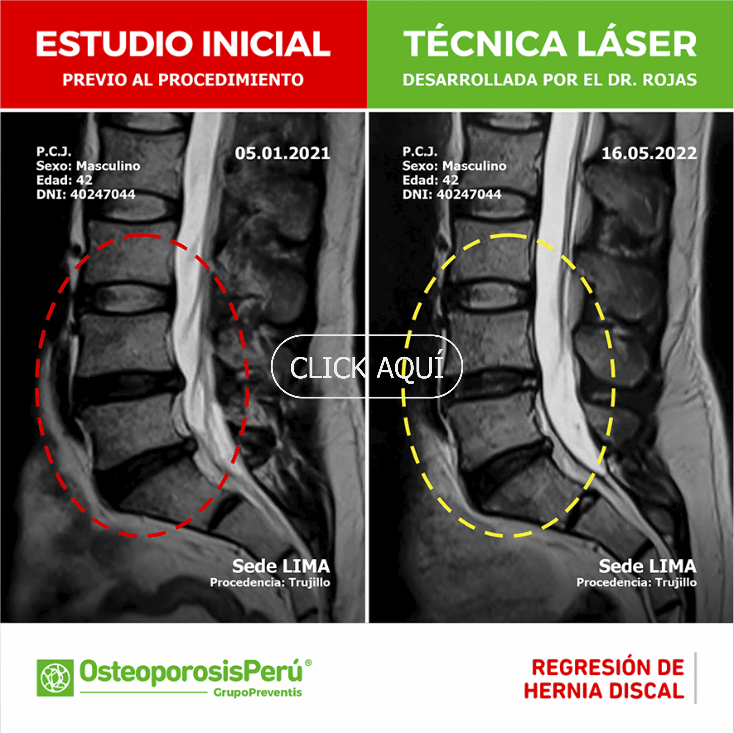 REGRESIÓN DE HERNIA DISCAL - RX - Osteoporosis Perú